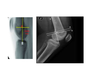 MPFL Reconstruction.pptx