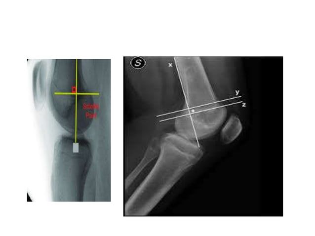 MPFL Reconstruction.pptx