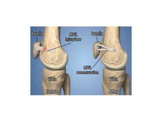 MPFL Reconstruction.pptx
