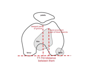 MPFL Reconstruction.pptx