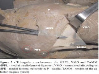 Medial Patellofemoral Ligament (MPFL) reconstruction 2014 | PPTX