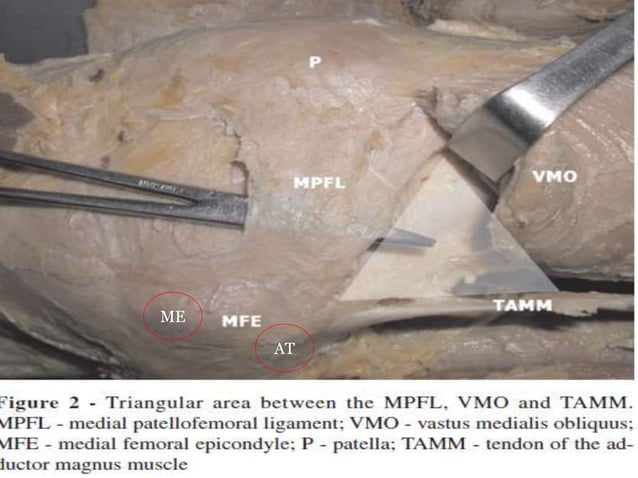 Medial Patellofemoral Ligament (MPFL) reconstruction 2014 | PPTX ...