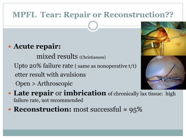 Medial Patellofemoral Ligament (MPFL) reconstruction 2014 | PPTX ...