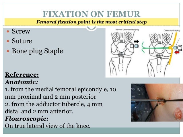Medial Patellofemoral Ligament (MPFL) reconstruction 2014