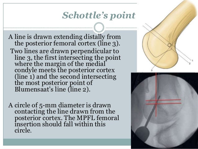Medial Patellofemoral Ligament (MPFL) reconstruction 2014
