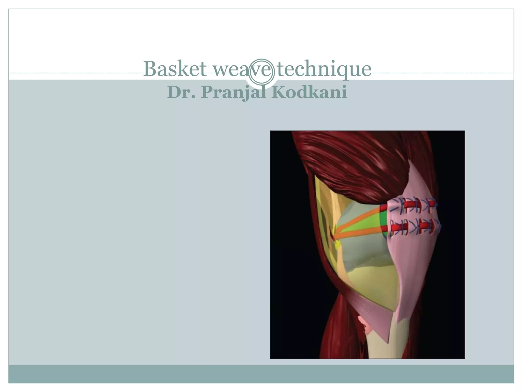 Medial patellofemoral ligament (MPFL) reconstruction | PPTX