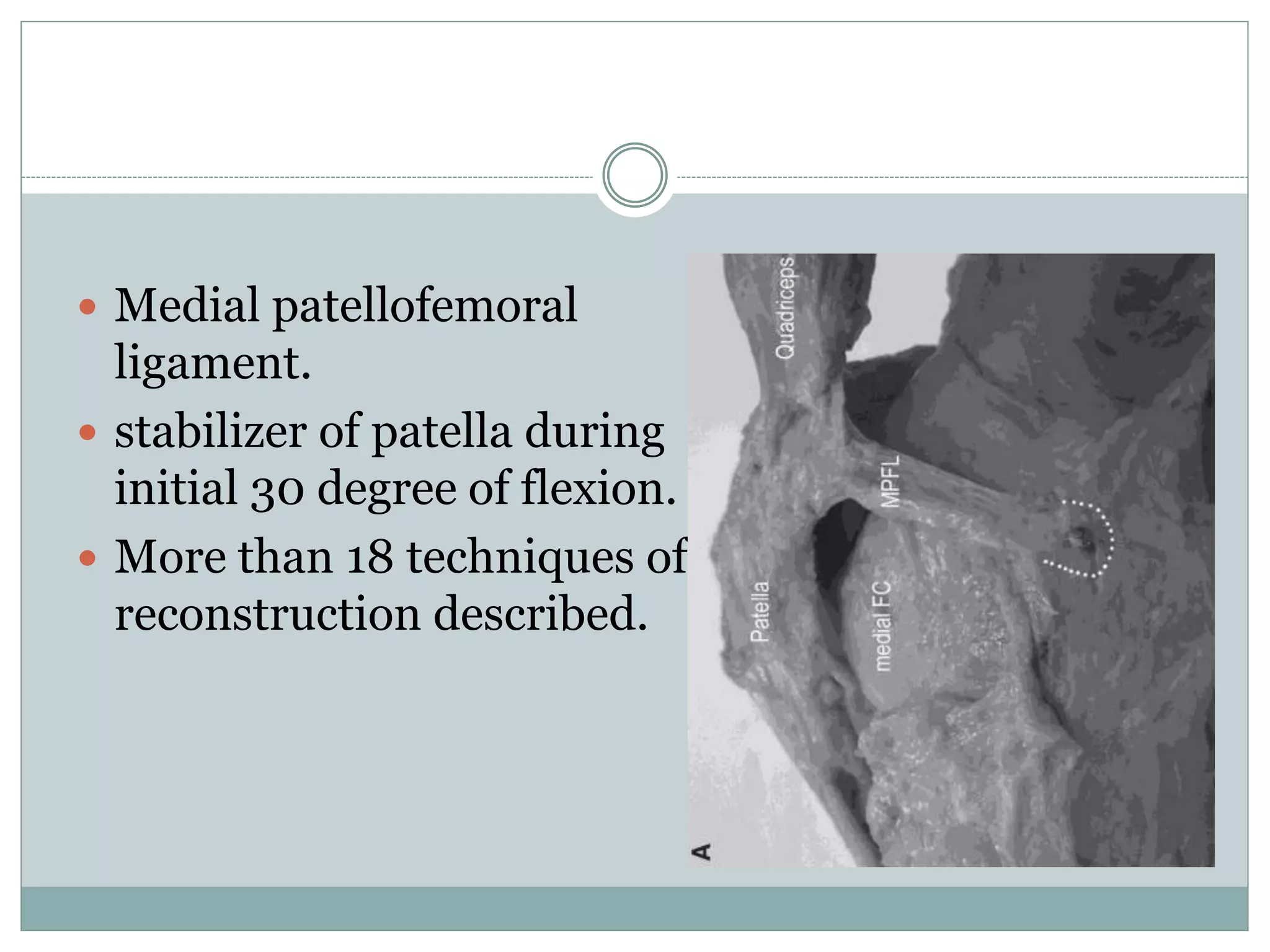 Medial patellofemoral ligament (MPFL) reconstruction | PPTX