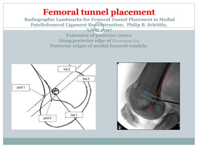 Medial patellofemoral ligament (MPFL) reconstruction | PPTX | Death ...