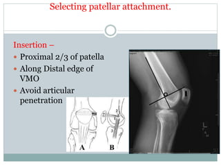 Medial patellofemoral ligament (MPFL) reconstruction | PPTX | Death ...