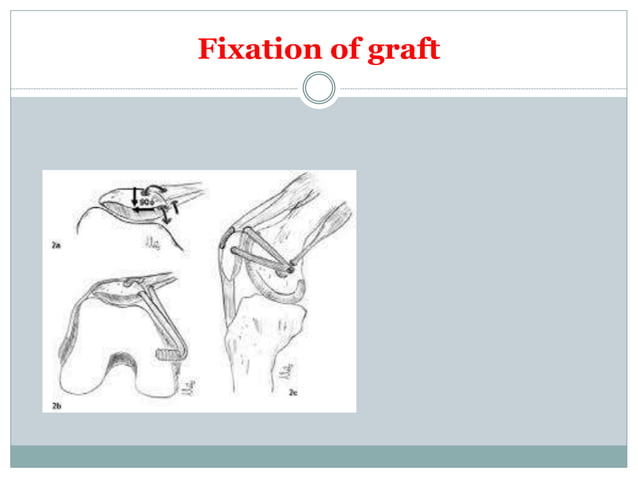 Medial patellofemoral ligament (MPFL) reconstruction | PPTX | Death ...
