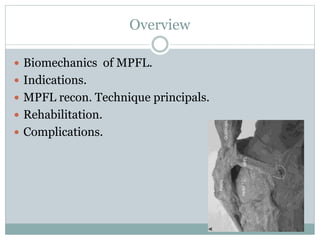 Medial patellofemoral ligament (MPFL) reconstruction | PPTX | Death ...