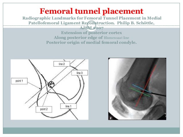 Medial patellofemoral ligament (MPFL) reconstruction