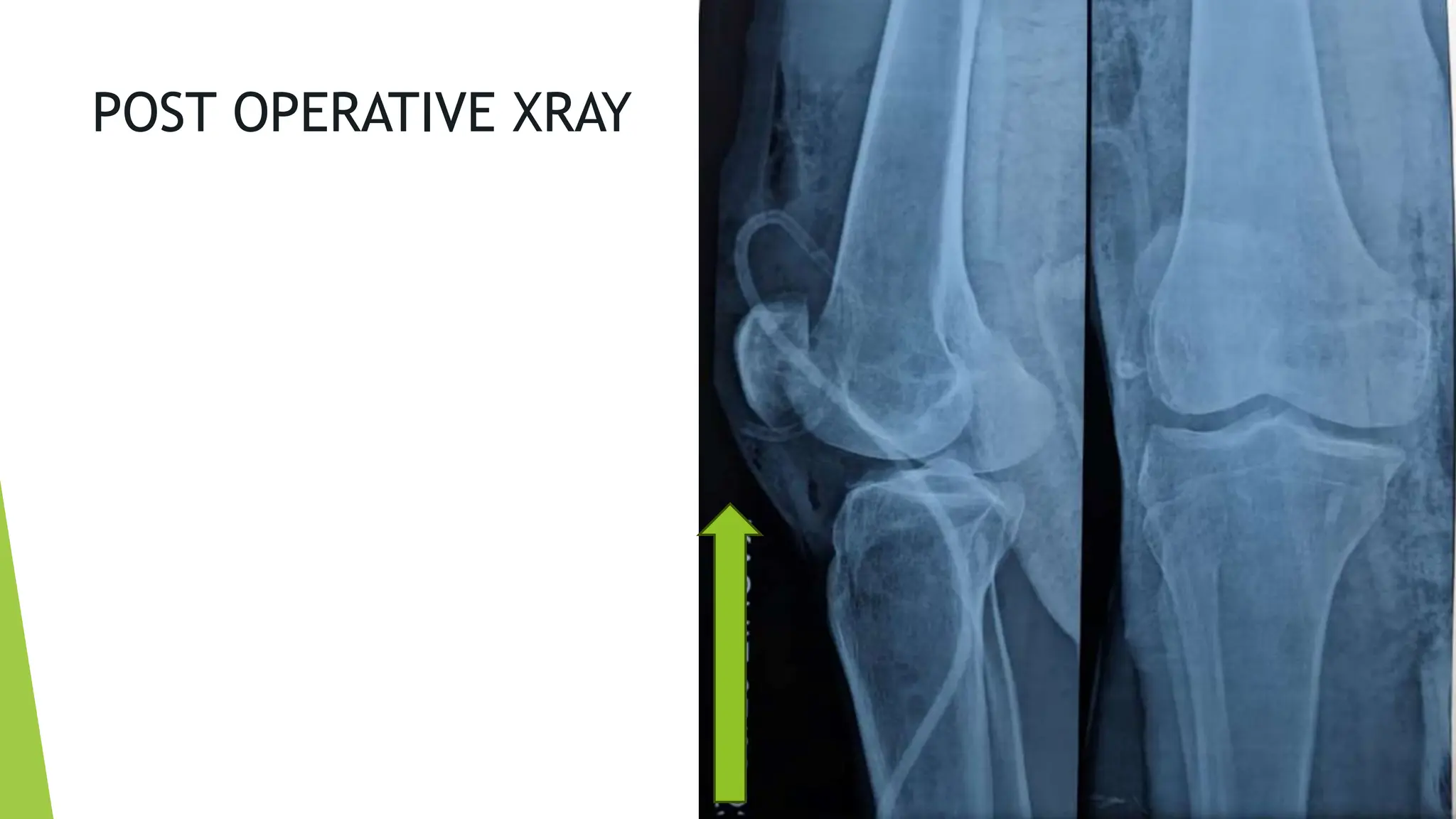 medial Patello femoral ligament (MPFL) Reconstruction | PPTX