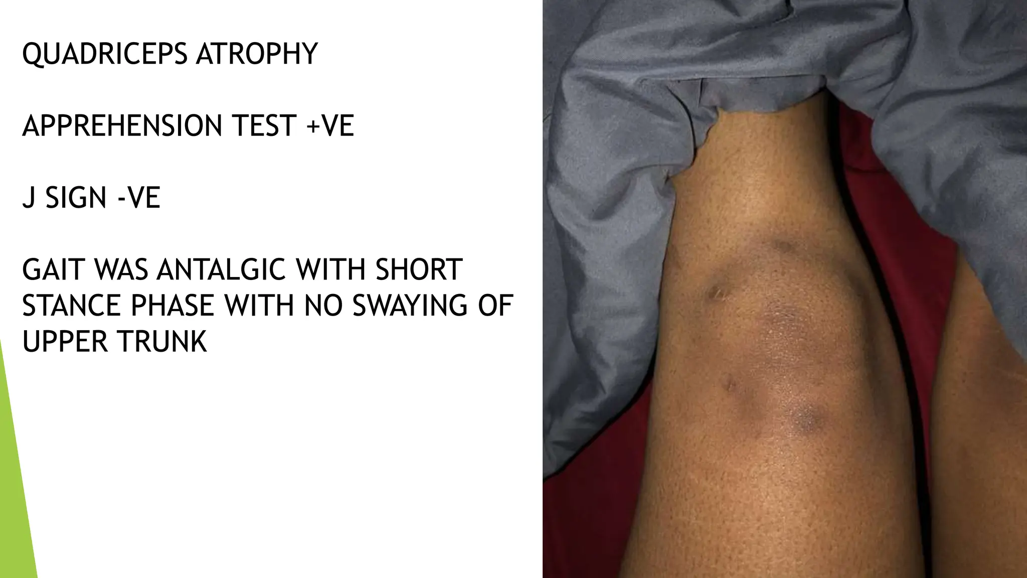 medial Patello femoral ligament (MPFL) Reconstruction | PPT