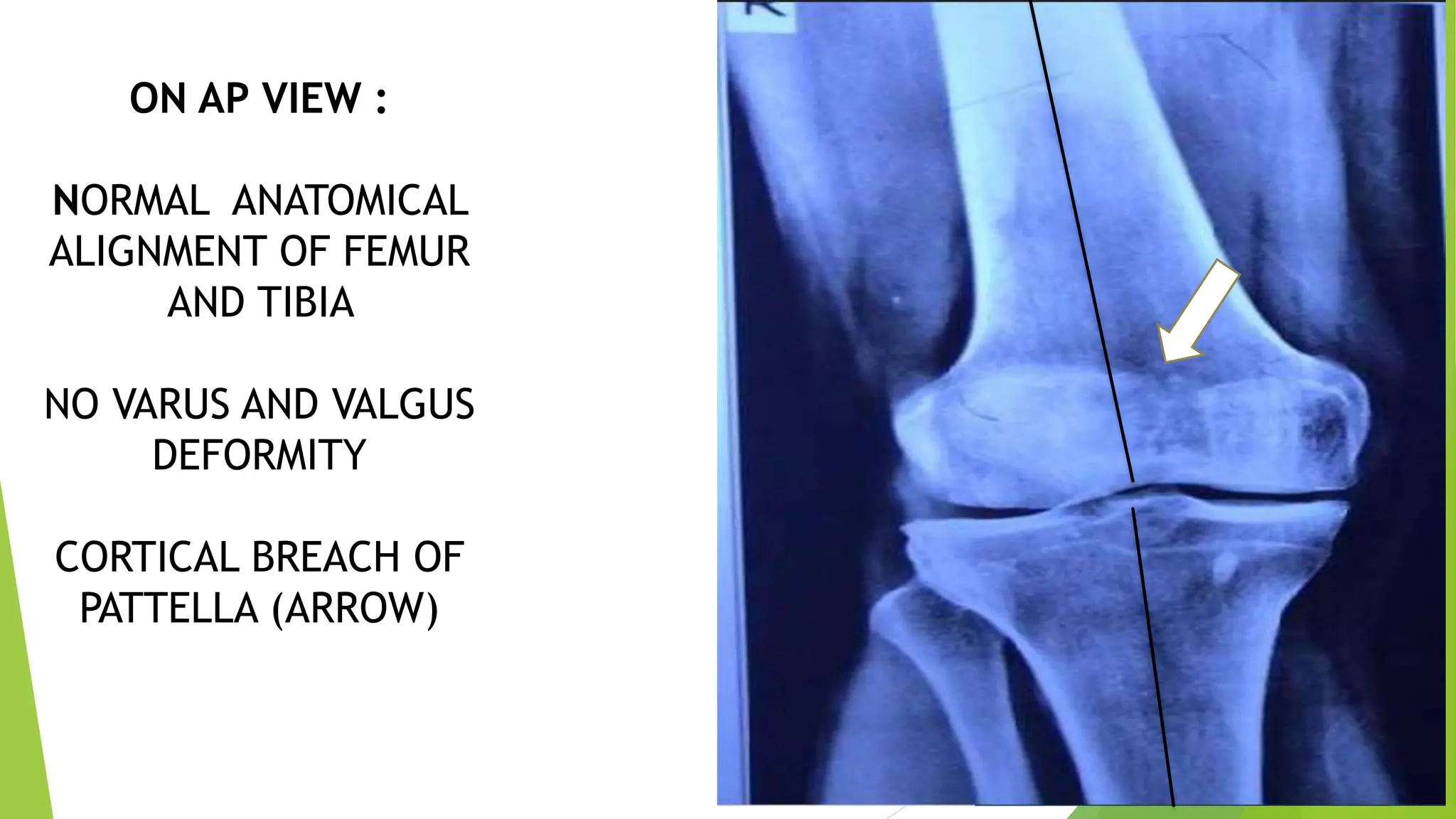 medial Patello femoral ligament (MPFL) Reconstruction | PPTX