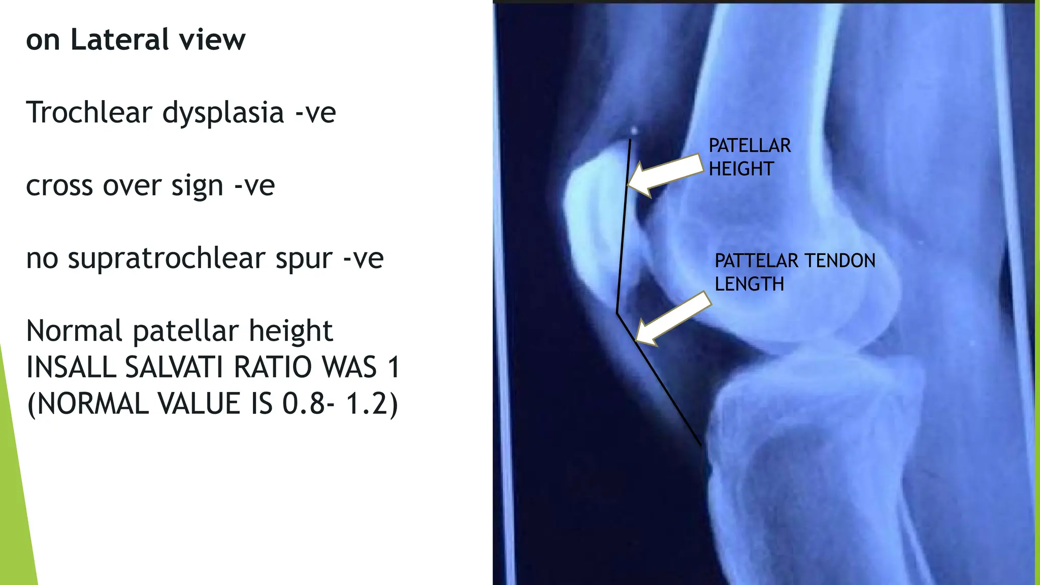 medial Patello femoral ligament (MPFL) Reconstruction | PPT