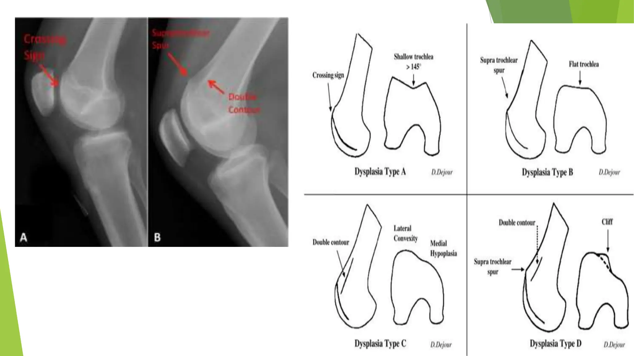 medial Patello femoral ligament (MPFL) Reconstruction | PPT