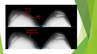medial Patello femoral ligament (MPFL) Reconstruction | PPT