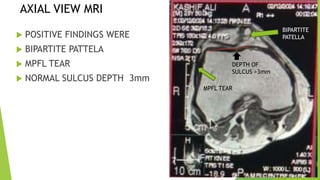 medial Patello femoral ligament (MPFL) Reconstruction | PPT