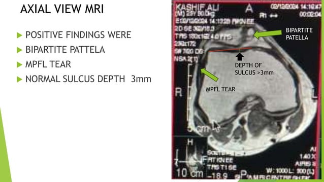 medial Patello femoral ligament (MPFL) Reconstruction | PPT