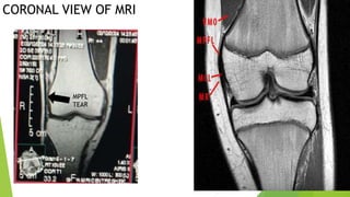 medial Patello femoral ligament (MPFL) Reconstruction | PPT