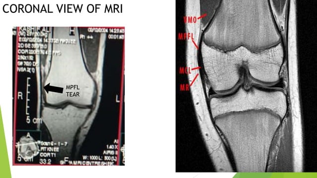 medial Patello femoral ligament (MPFL) Reconstruction | PPT