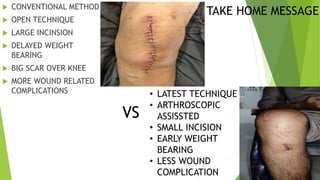 medial Patello femoral ligament (MPFL) Reconstruction | PPT