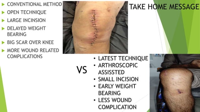 medial Patello femoral ligament (MPFL) Reconstruction | PPT