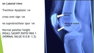 medial Patello femoral ligament (MPFL) Reconstruction | PPT