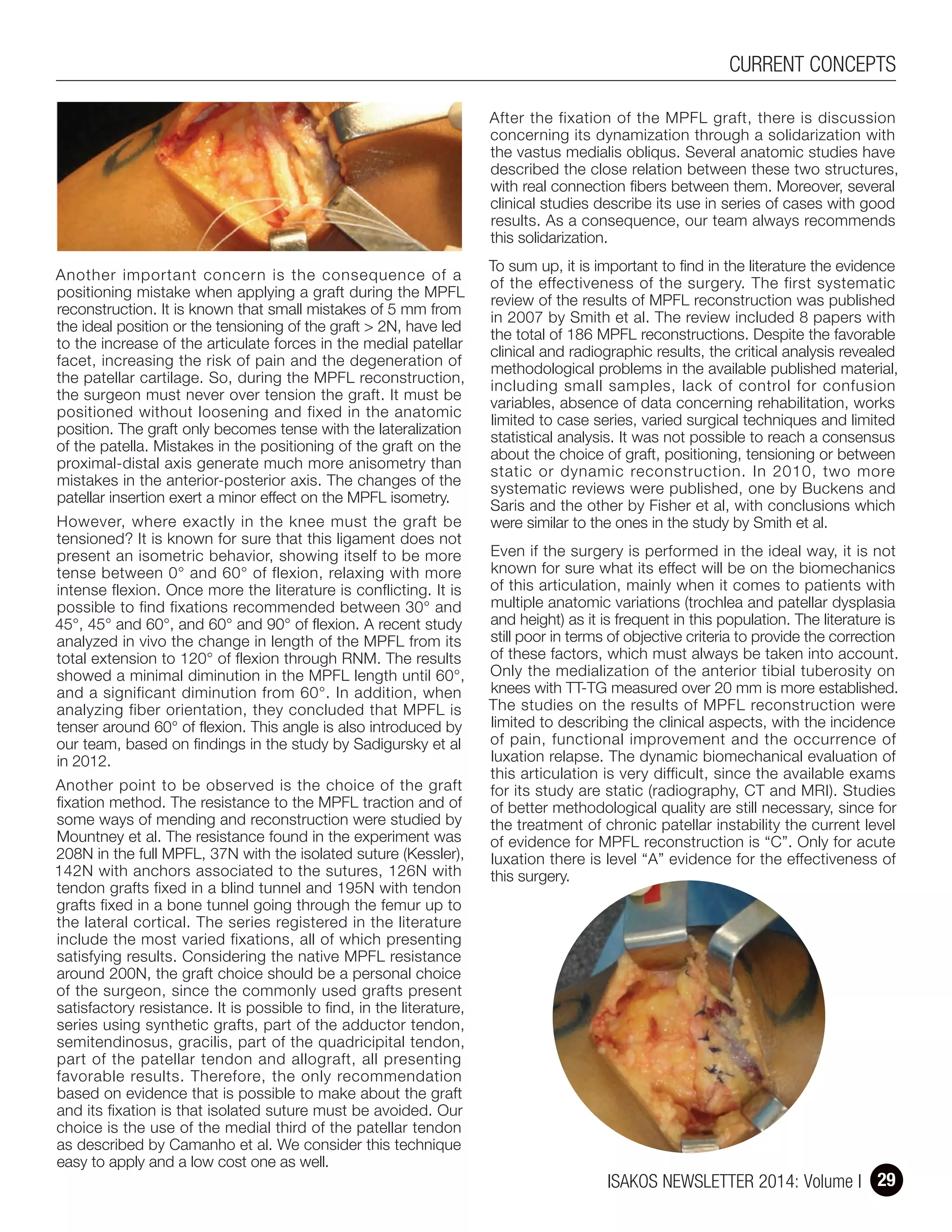 Medial Patellofemoral Ligament Reconstruction with Patellar Tendon | PDF