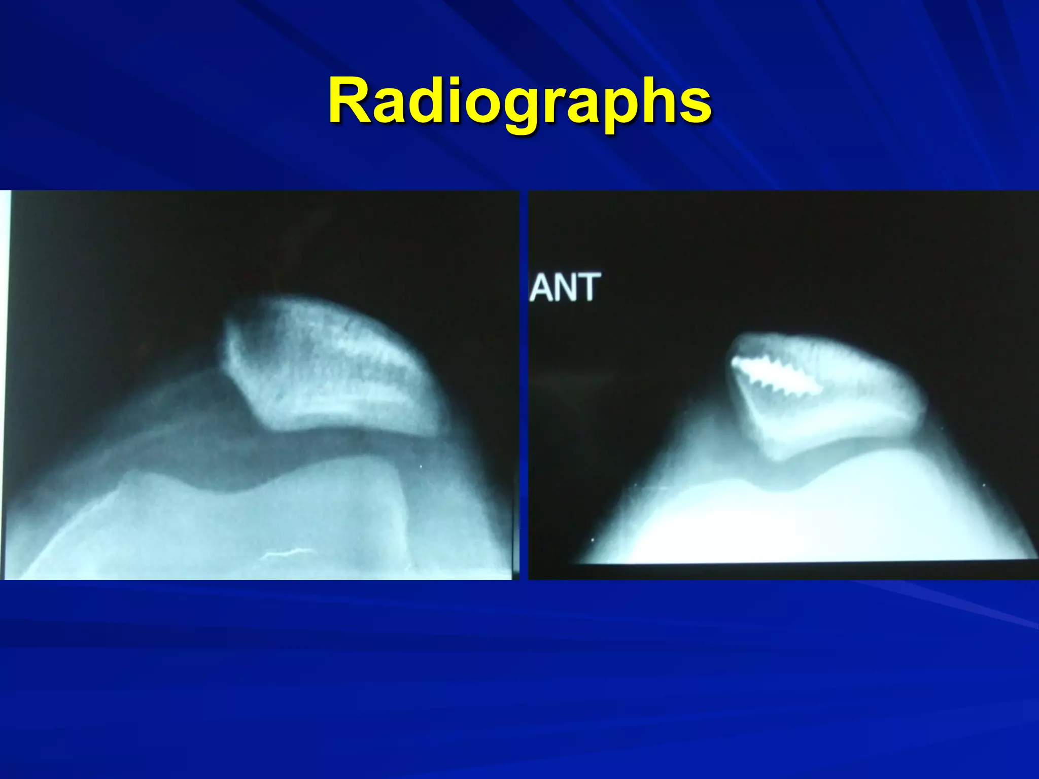 Mpfl tech - MPFL Reconstruction for Patellar Instability | PDF