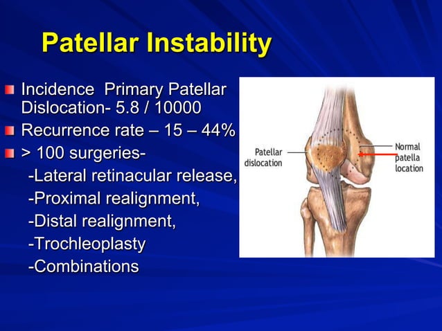 Mpfl tech - MPFL Reconstruction for Patellar Instability | PPT
