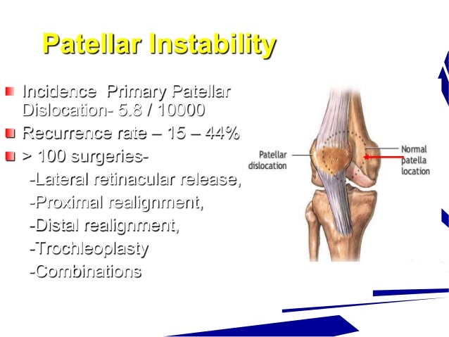 Mpfl tech - MPFL Reconstruction for Patellar Instability