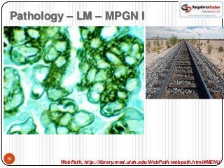 Membranoproliferative Glomerulonephritis - Diagnostic Road for Etiology ...