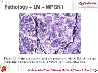Membranoproliferative Glomerulonephritis - Diagnostic Road for Etiology ...
