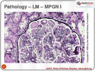 Membranoproliferative Glomerulonephritis - Diagnostic Road for Etiology ...