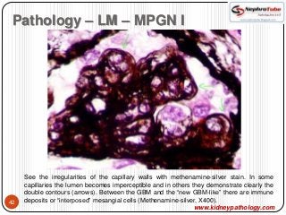 Membranoproliferative Glomerulonephritis - Diagnostic Road for Etiology ...