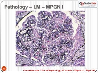 Membranoproliferative Glomerulonephritis - Diagnostic Road for Etiology ...