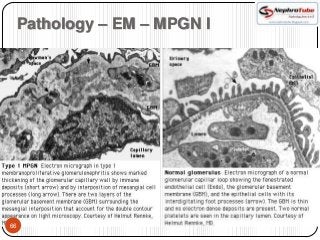 Membranoproliferative Glomerulonephritis - Diagnostic Road for Etiology ...