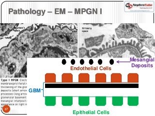 Membranoproliferative Glomerulonephritis - Diagnostic Road for Etiology ...