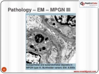 Membranoproliferative Glomerulonephritis - Diagnostic Road for Etiology ...