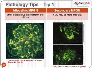 Membranoproliferative Glomerulonephritis - Diagnostic Road for Etiology ...