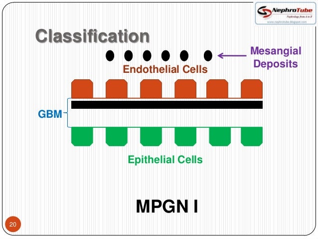 Membranoproliferative Glomerulonephritis - Diagnostic Road for Etiology ...