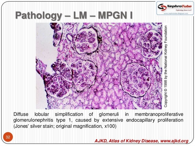 Membranoproliferative Glomerulonephritis - Diagnostic Road for Etiology ...