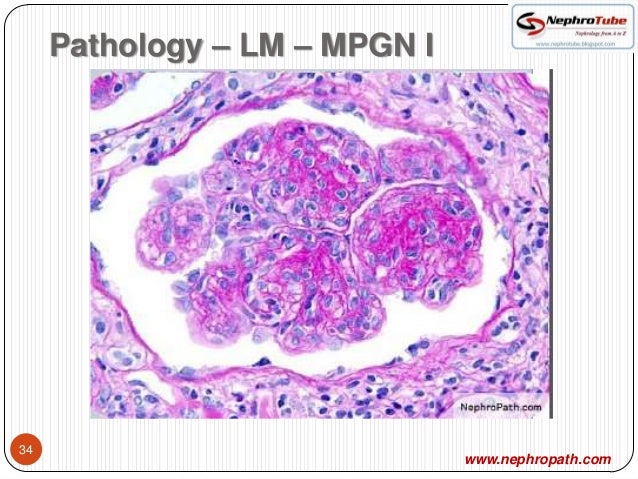 Membranoproliferative Glomerulonephritis - Diagnostic Road for Etiology ...