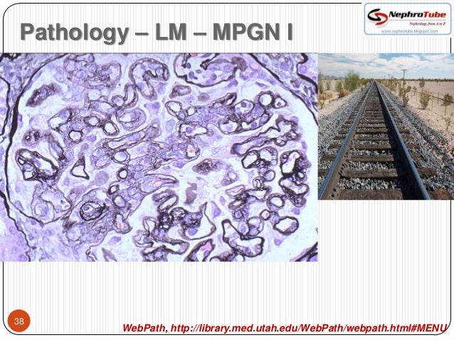 Membranoproliferative Glomerulonephritis - Diagnostic Road for Etiology ...