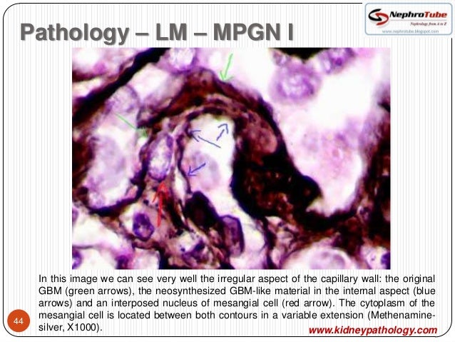 Membranoproliferative Glomerulonephritis - Diagnostic Road for Etiology ...