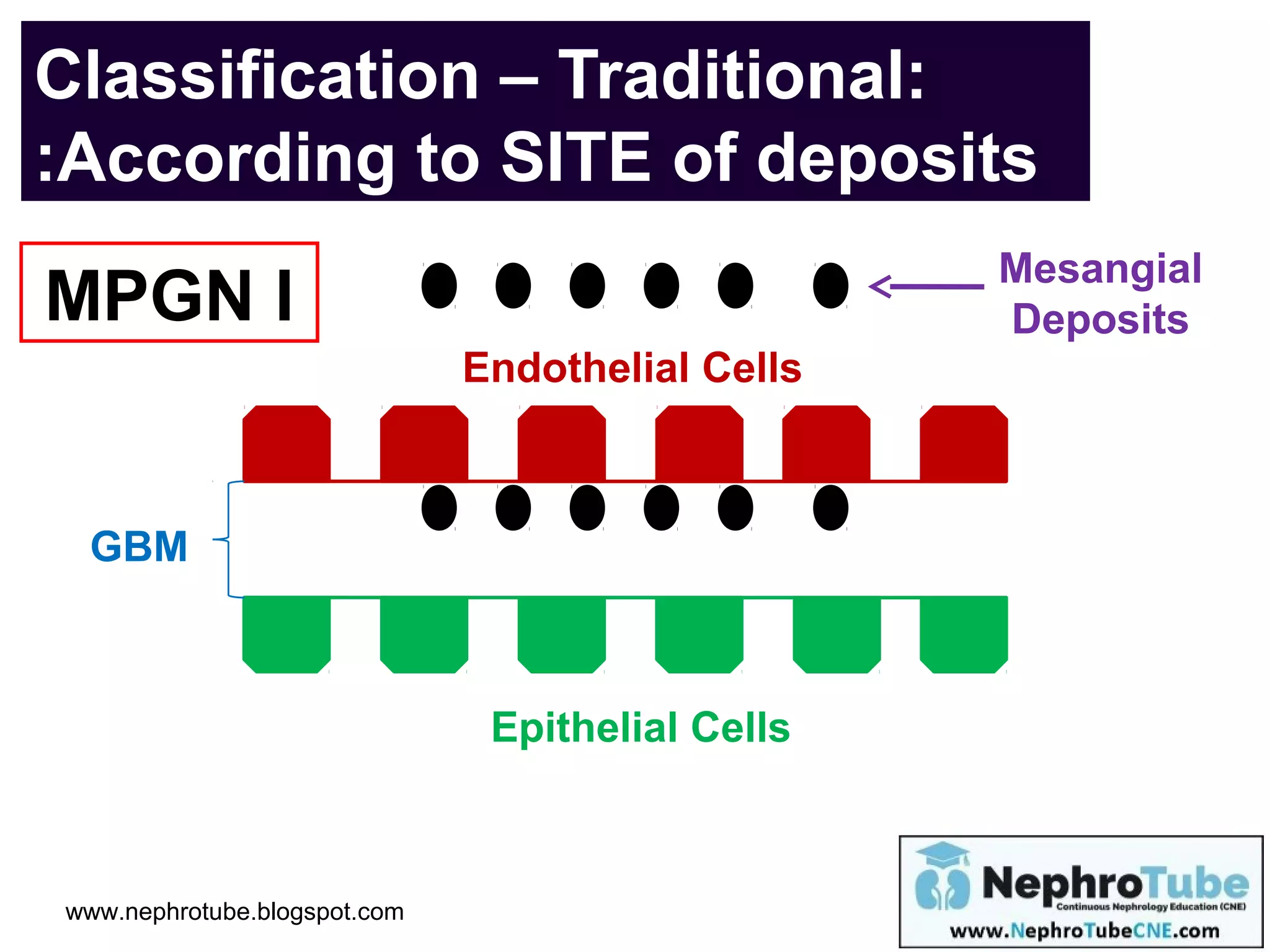 Membranoproliferative GN - Road to Diagnosis & Management - What is the ...
