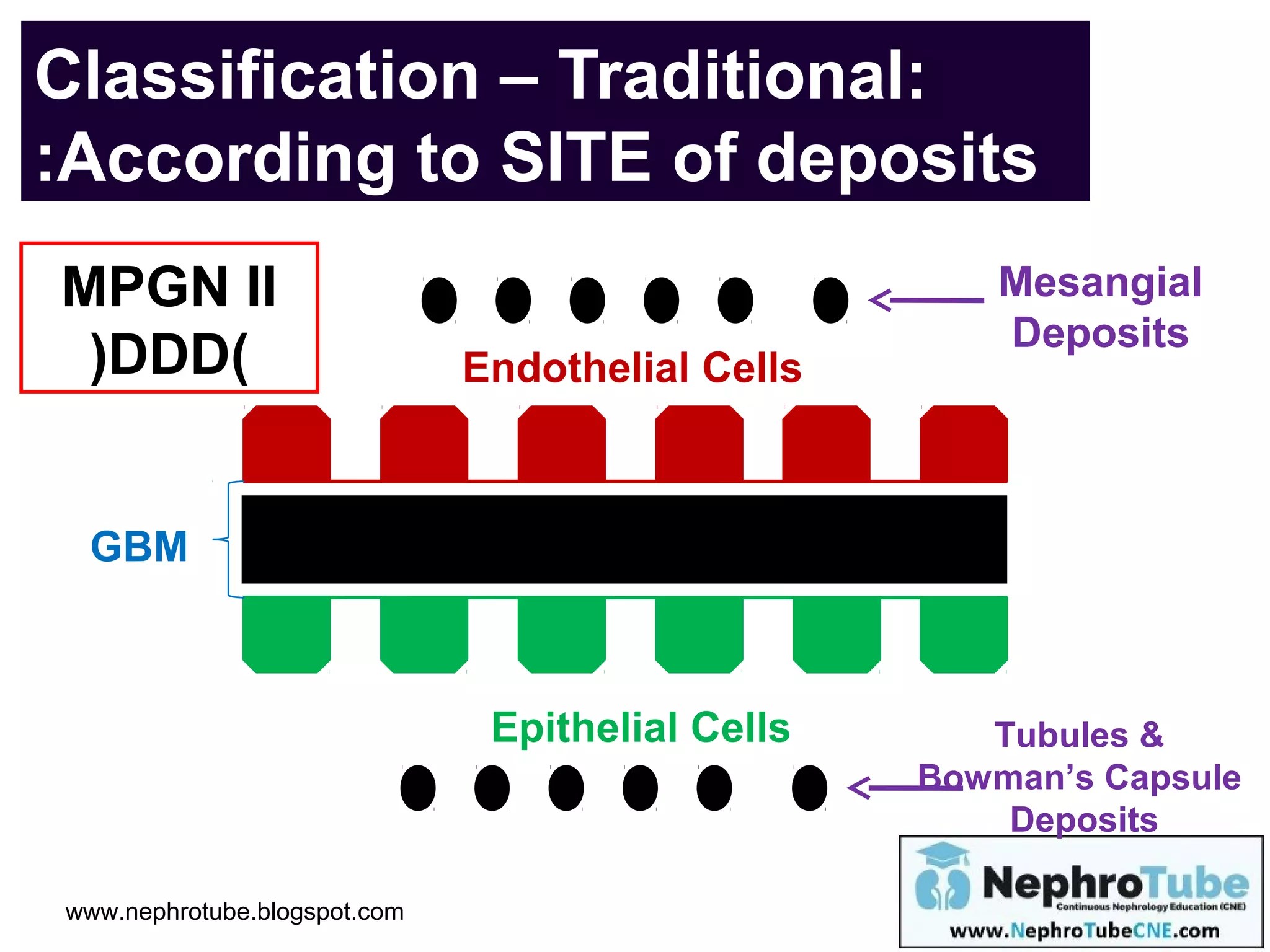 Membranoproliferative GN - Road to Diagnosis & Management - What is the ...