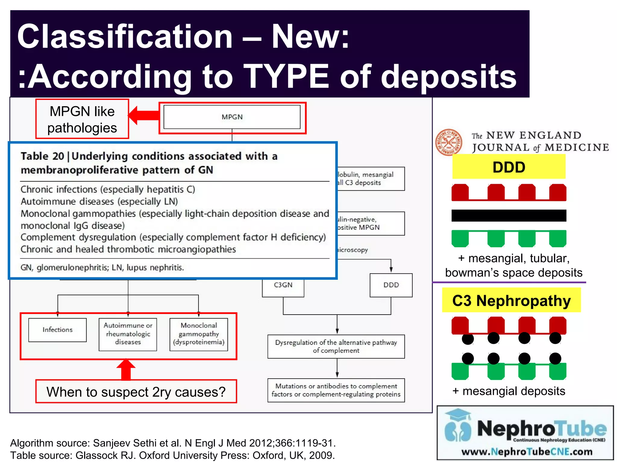 Membranoproliferative GN - Road to Diagnosis & Management - What is the ...